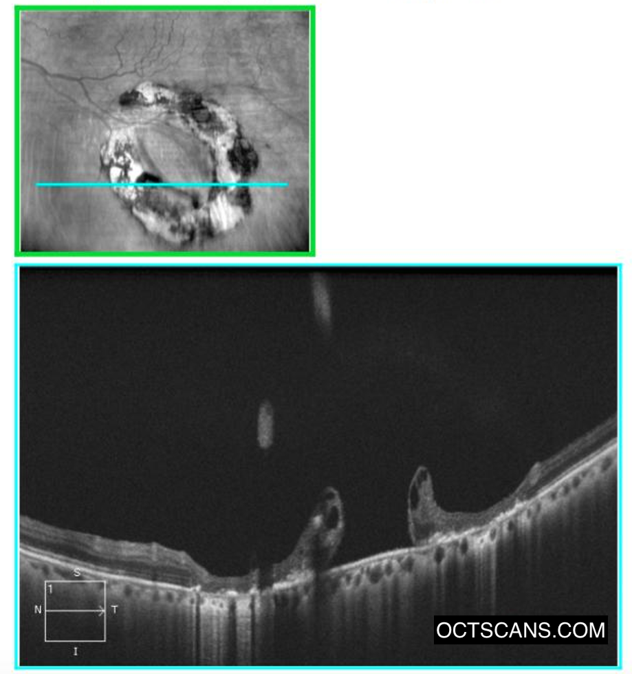 PERIPHERAL RETINAL HOLE – OCTSCANS.COM