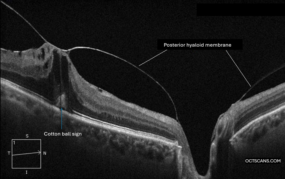 VITREOMACULAR TRACTION – OCTSCANS.COM