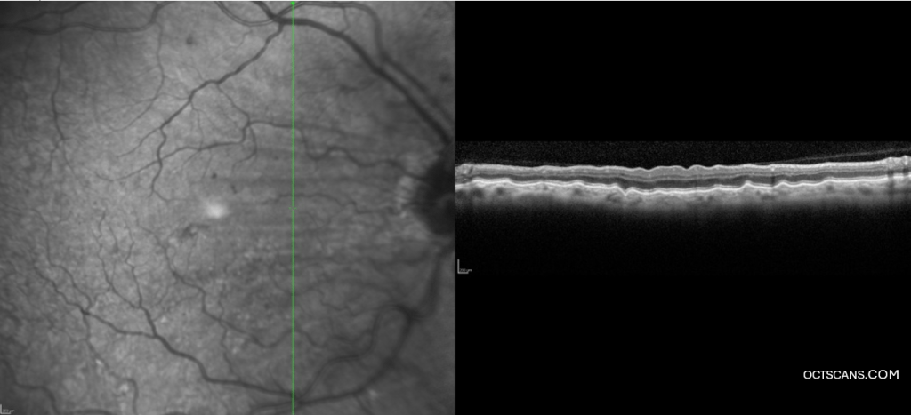 CHOROIDAL FOLDS – OCTSCANS.COM